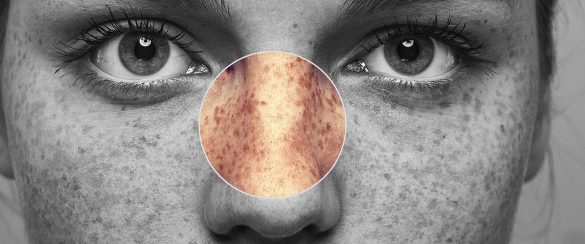 Addressing Hyperpigmentation and Dark Spots: A Comprehensive Guide to ...