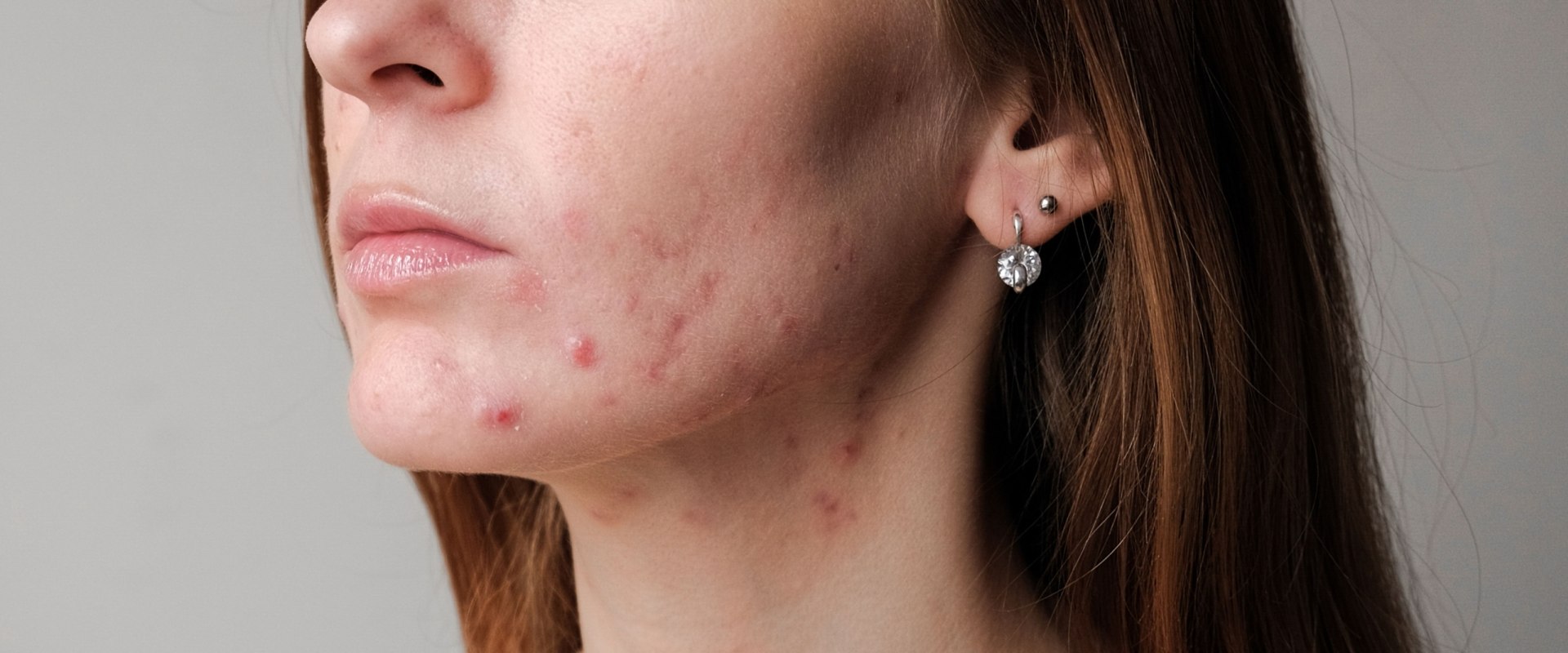 Managing Acne and Breakouts: Your Complete Guide to Clearer Skin